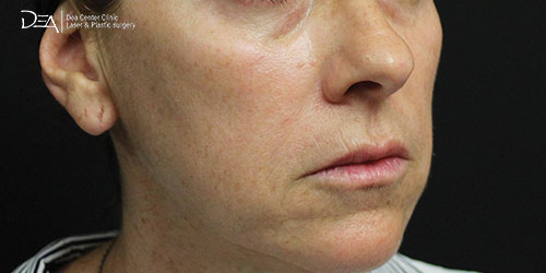 Real Before and After Results with PLLA Filler - Lanluma