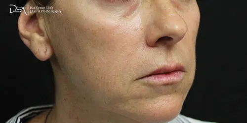 Real Before and After Results with PLLA Filler - Lanluma