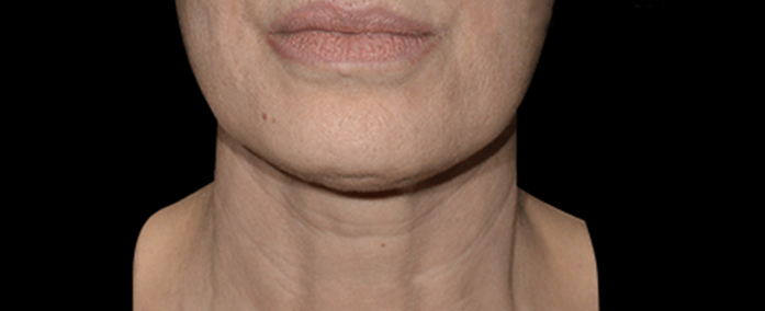 Real Before and After Results with PLLA Filler - Lanluma
