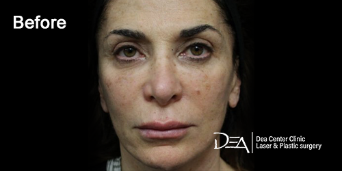 Areas You Can Enhance With Lanluma Injections - Lanluma