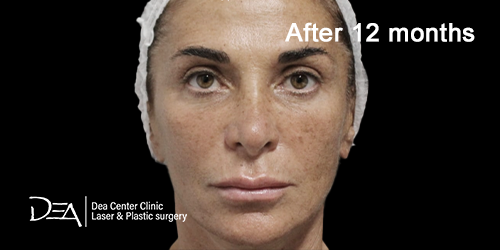 Areas You Can Enhance With Lanluma Injections - Lanluma