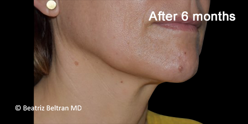 Areas You Can Enhance With Lanluma Injections - Lanluma